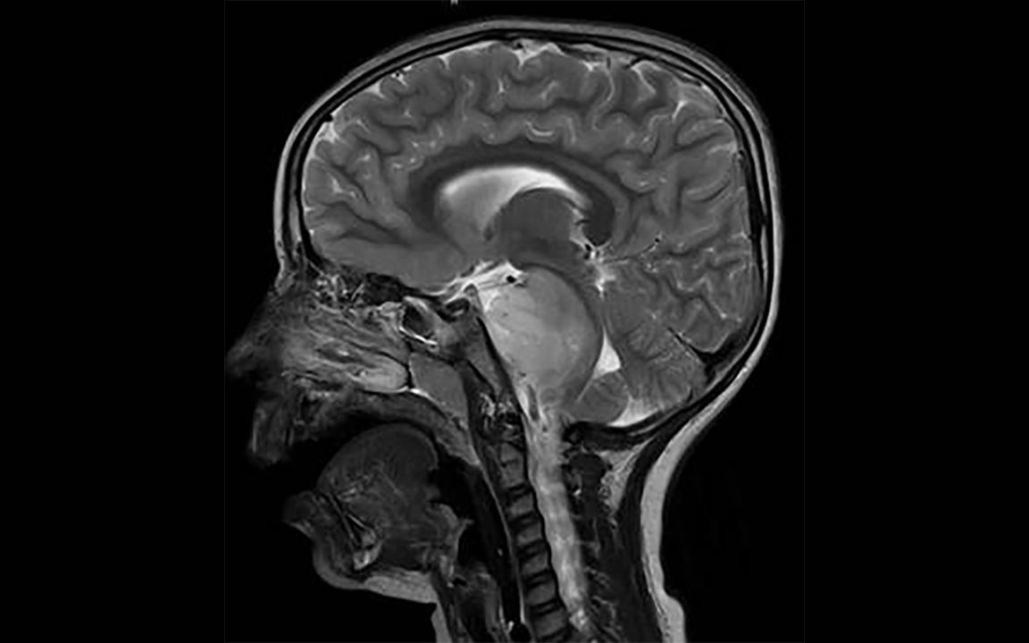 New Immunotherapy for Deadly Childhood Brain Cancer Targets Novel ...